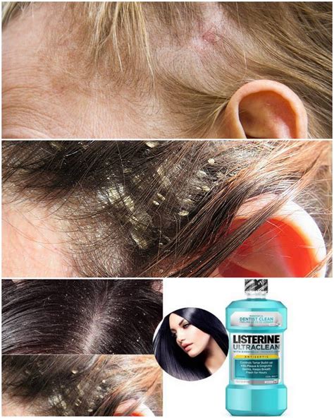 Listerine For Scalp Fungus Listerine Foot Soak