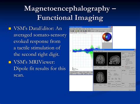 Ppt Magnetoencephalography Powerpoint Presentation Free Download Id 92005