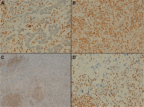 Representative Example Of Arid1a And Runx3 Expression In Gastric