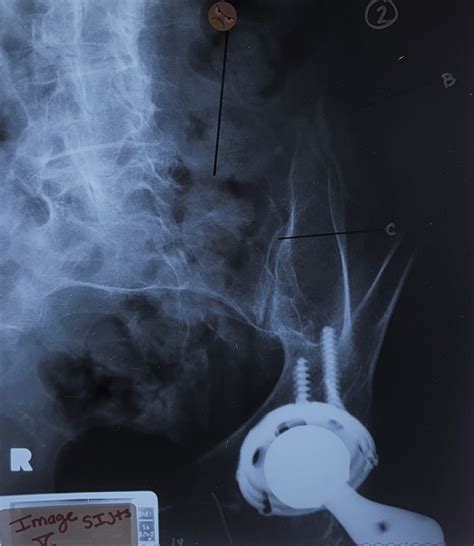 SI JOINT LEFT Diagram Quizlet
