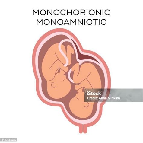 Monochorionic Monoamniotic Twins Stock Illustration Download Image