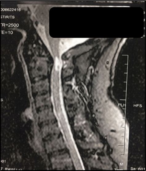 Postoperative Cervical Spine Ap And Lateral Views With C1 C2 Fixation Download Scientific Diagram