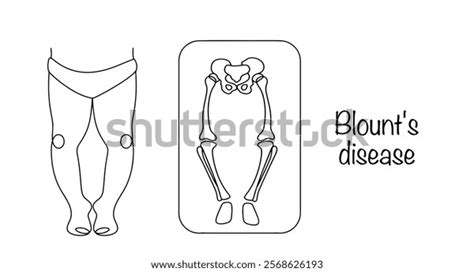 Proximal Tibia Deformity Internal Tibia Deformity Stock Vector Royalty