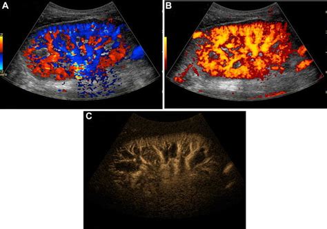 A 39 Year Old Male 1 Day Status Post Renal Transplant For Routine
