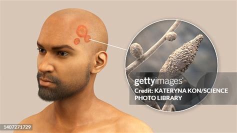 Ringworm Illustration High Res Vector Graphic Getty Images