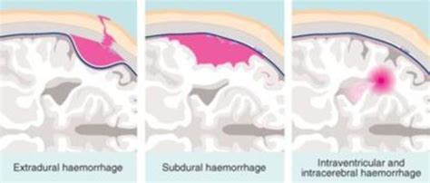 Subdural Epidural Anesthesia Key