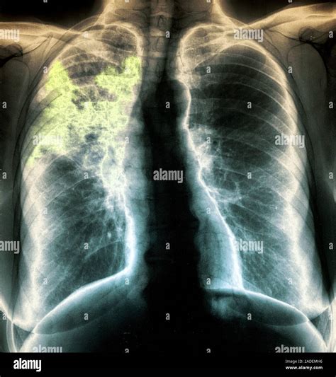 Pneumonia Frontal Chest X Ray Of A 60 Year Old Patient Showing A Opacity Of The Right Apico