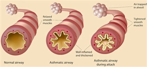 Anaphylaxis And Asthma