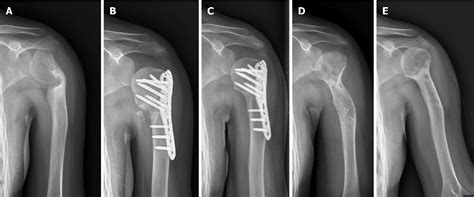 Figure 3 From Simple Bone Cysts Of The Proximal Humerus Presented With