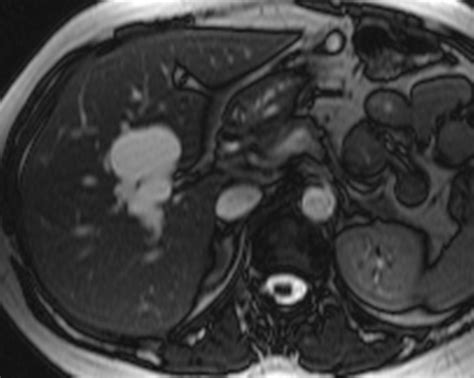 Liver Atlas Case 224 Choledochal Cyst Todani Type 2 Originating