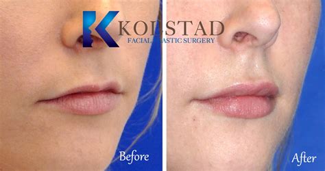 Best Lip Filler San Diego Before And After Photo Gallery 37 Dr Kolstad
