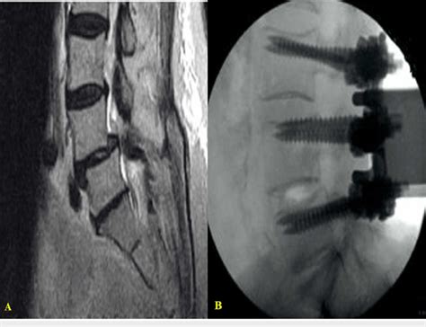 A Ct Lumbar Spine Sagittal View Shows Severe Spinal Stenosis Due To