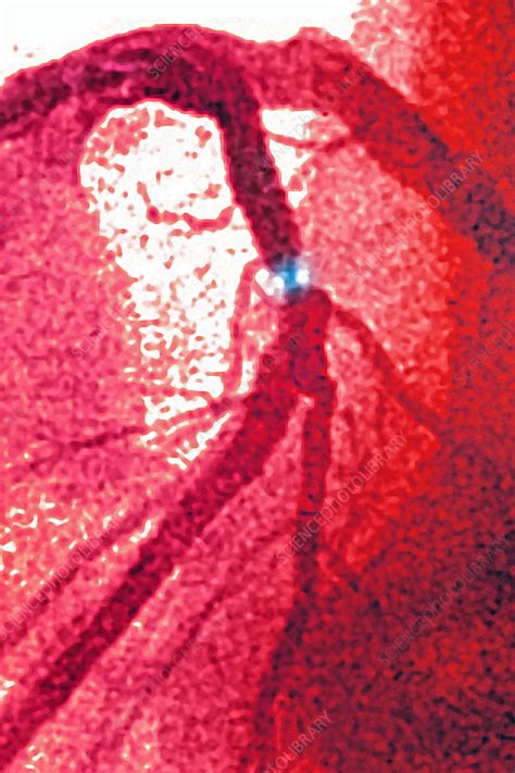 Myocardial Infarction Angiogram Stock Image C036 5916 Science