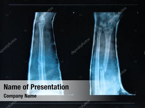 Fracture X Ray Show Radius Bone Powerpoint Template Fracture X Ray