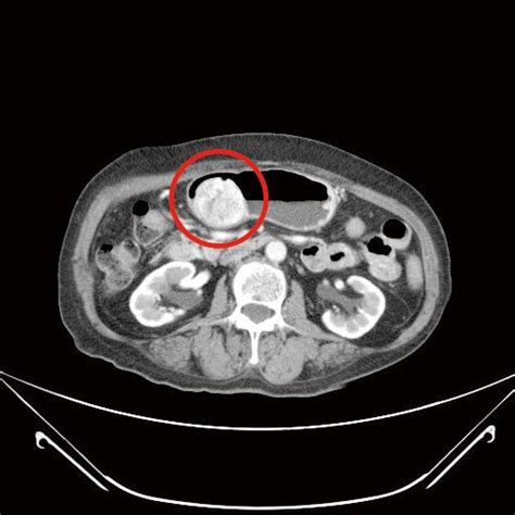 僅佔2！她腹痛又血便胃腸竟檢出「6公分大惡性腫瘤」膽囊還被結石塞滿 祝你健康 三立新聞網 Healthsetncom