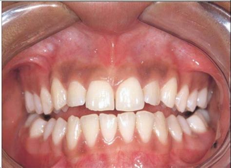 Physiologic Pigmentation Racial Pigmentation 2 Download Scientific