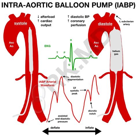 What Is An Intra Aortic Balloon Pump IABP RK MD