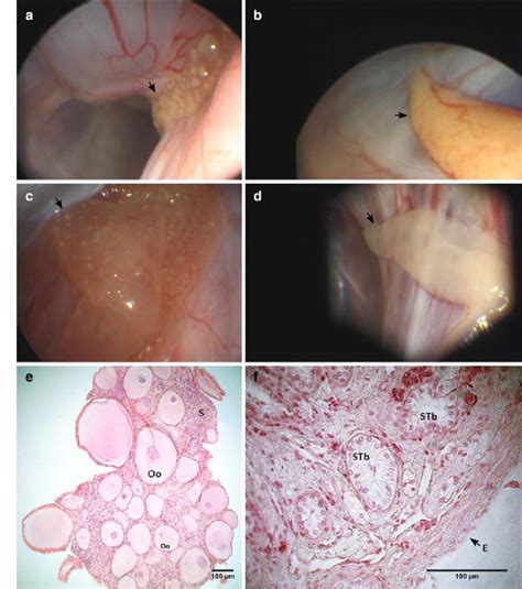 Macroscopic Laparoscopy Ad And Microscopic Histology E F