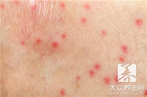 皮肤出现红点不痛不痒是什么病 壹读