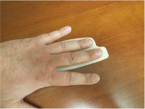 Proximal Interphalangeal Joint Extension Block Splint Jack 48 Off
