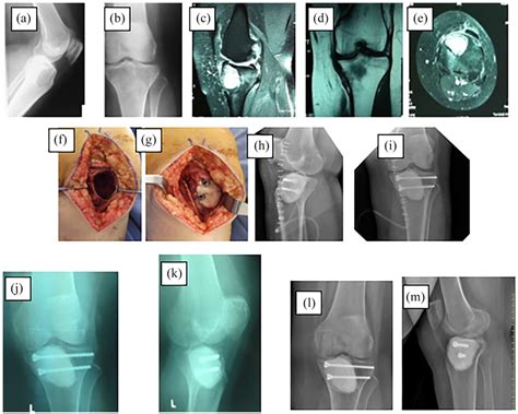 Giant Cell Tumor In The Proximal Tibia A And B Preoperative Graph