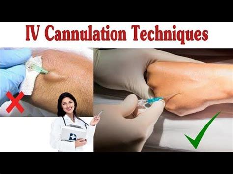 IV Cannulation Technique Medical Video L Techniques