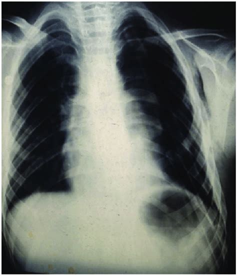 Plain Chest Radiography Revealed Left Sided Pneumothorax And Two