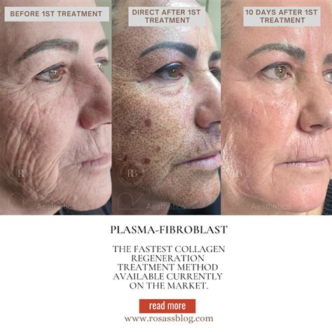 Full Face Plasma Fibroblast 3 Weeks Update