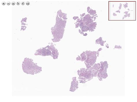 34 Crohns Disease Histopathology Atlas