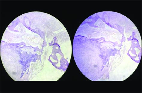 Histopathology Of Excised Tumour Low Power 10x And High Power 40x