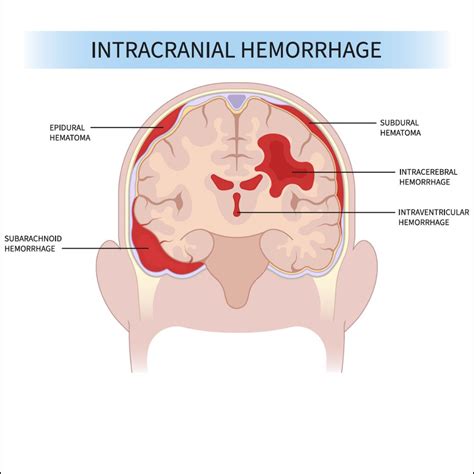 Intraparenchymal Hemorrhage Causes