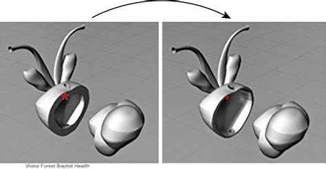 Robotic Simple Prostatectomy Basicmedical Key