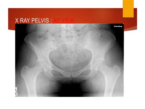 Pelvic Fracture Ppt By Dr Bharti Pawar Ppt