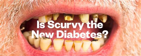 Is Scurvy The New Diabetes Matter Medium