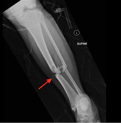 Tibia And Fibula