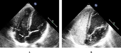Pdf Atrial Septal Aneurysm A Major Diagnostic Clue For A Patent