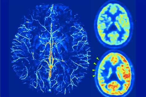 Studypages Magnetic Resonance Imaging MRI To Measure Brain Vessels