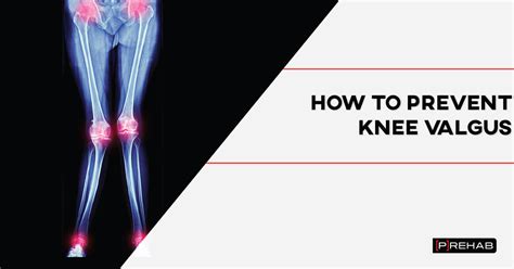 How To Prevent Knee Valgus 𝗣 𝗥𝗲𝗵𝗮𝗯