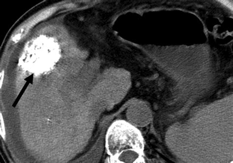 Imaging Features Of Hepatocellular Carcinoma After Transcatheter