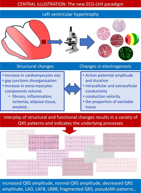 Left Ventricular Hypertrophy Lvh How To Recognize It On 59 Off
