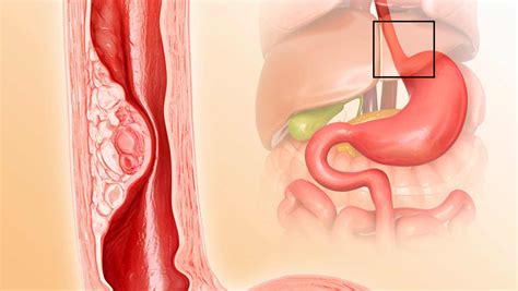 Esophageal Varices Treatment Medical And Surgical Options