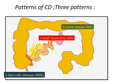 Inflammatory Bowel Diseases Ibd Ppt
