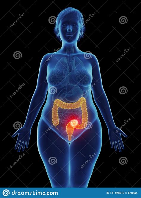 A Tumor In The Rectum The Structure Of The Rectum Of The Intestine