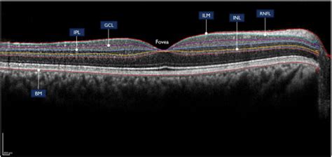 Image Of Optical Coherence Tomography Automated Segmentation Of The Download Scientific Diagram
