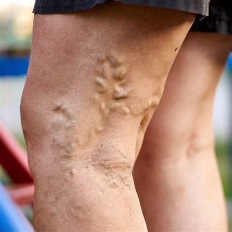 Varicose Veins Cause And Risk Factors Symptoms Of Varicose Veins AngioLife