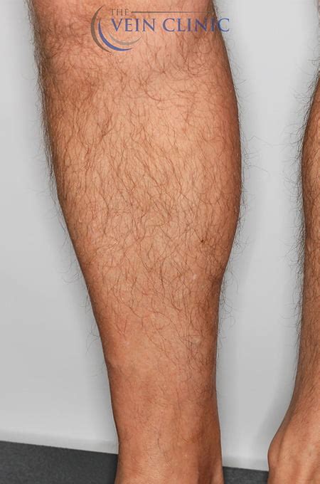 Varicose Vein Treatment Before And After Vein Clinic Perth