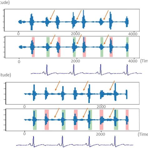 schematic diagram of the segmentation of the heart sound from a patient