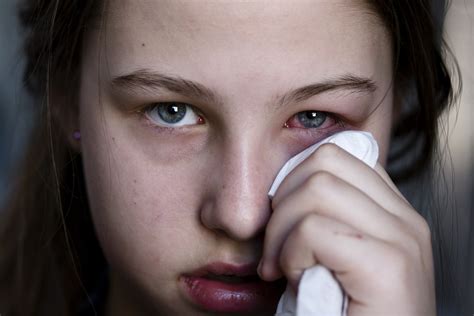 Estresse Herpes Ocular E Cegueira Qual A Rela O Holhos