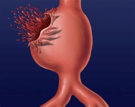 Aneurizma Trbušne Aorte Da Li Uvek Mora Hirurgija Operacija Srca