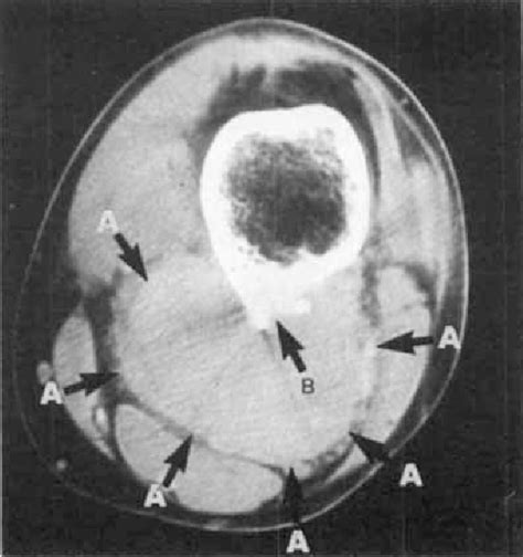 Figure 2 From Pseudoaneurysm Of The Popliteal Artery As A Complication Of An Osteochondroma